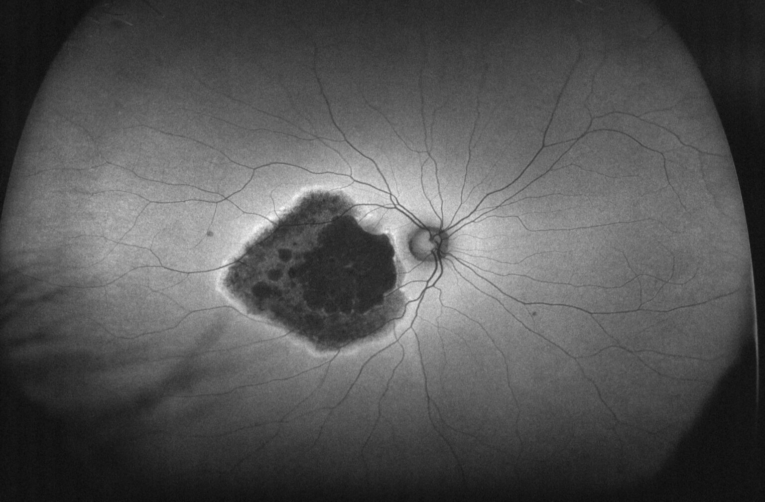 Pérdida de visión central ¿a qué se debe? | Miranza