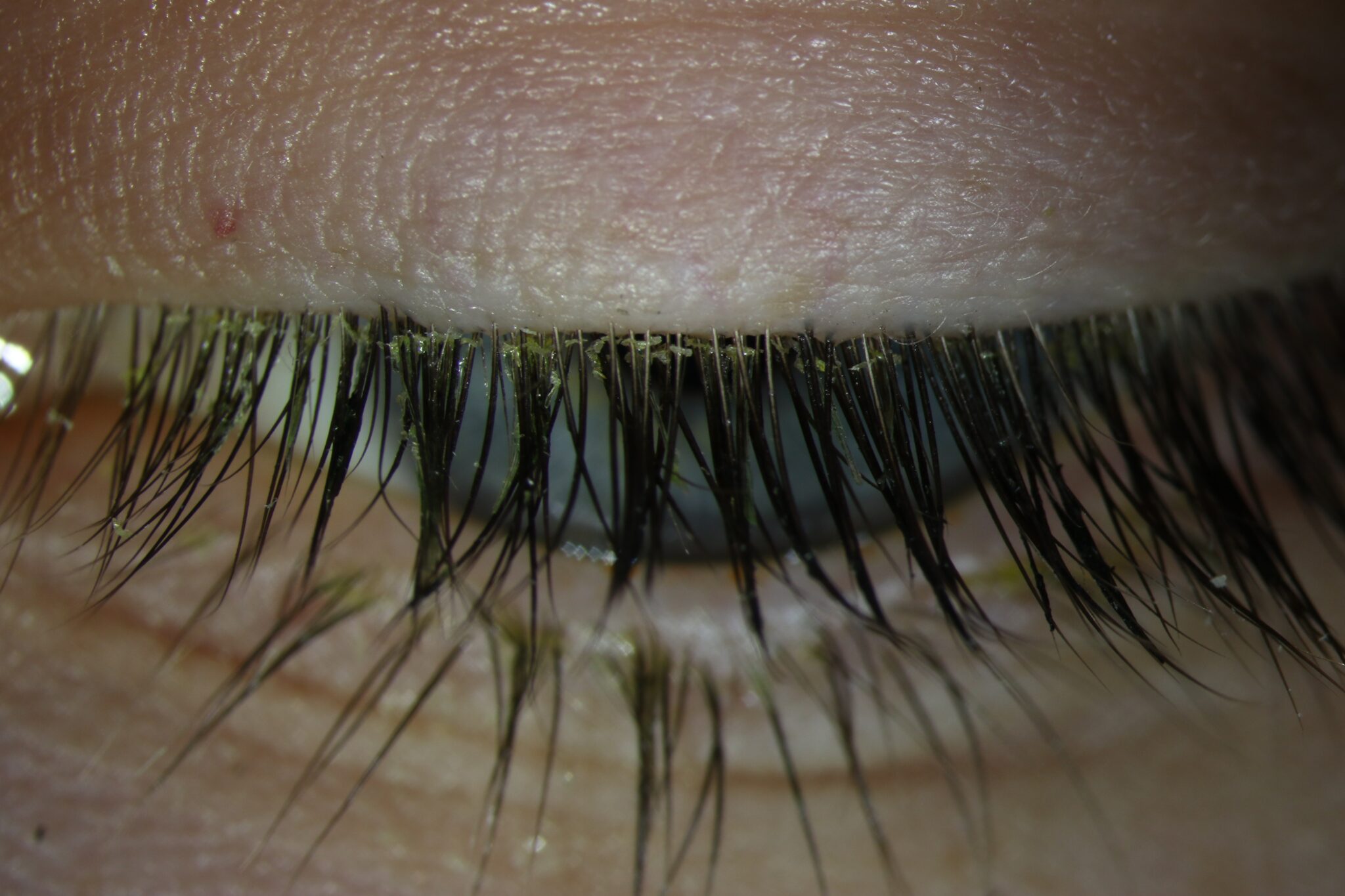 Blefarite, o que é e como é causada? | Miranza