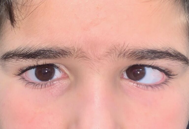 Children’s strabismus - Miranza