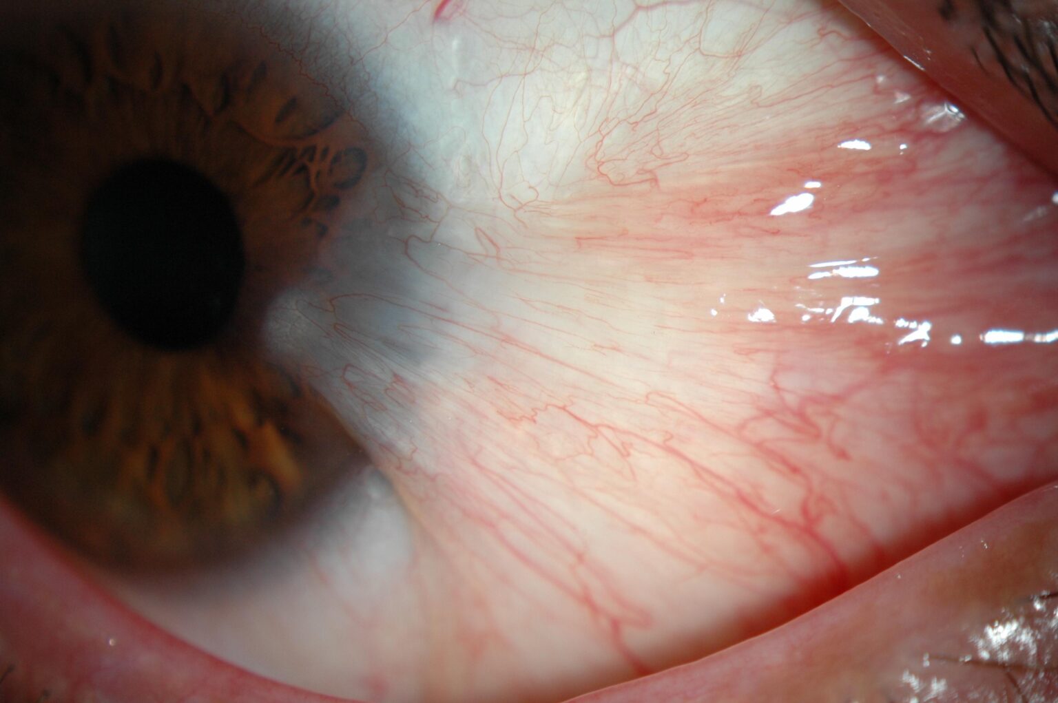 Pterygium | Miranza
