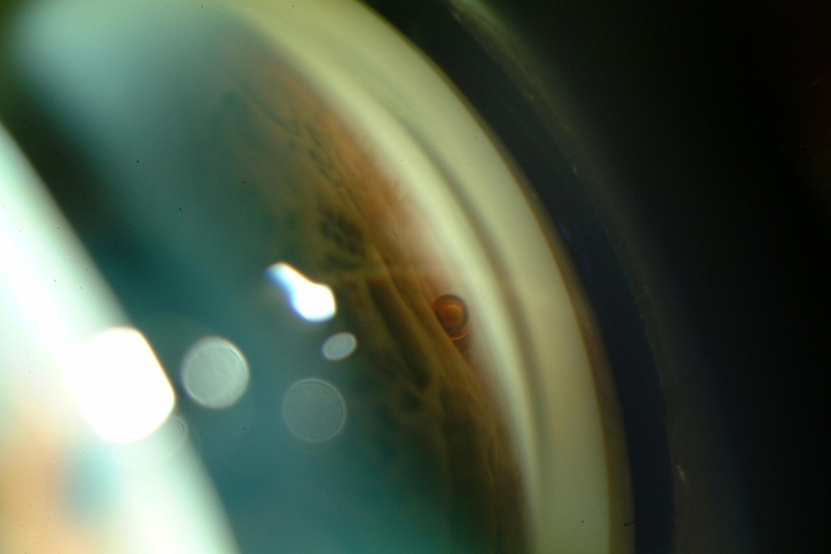 MIGS: Minimally Invasive Glaucoma Surgery | Miranza